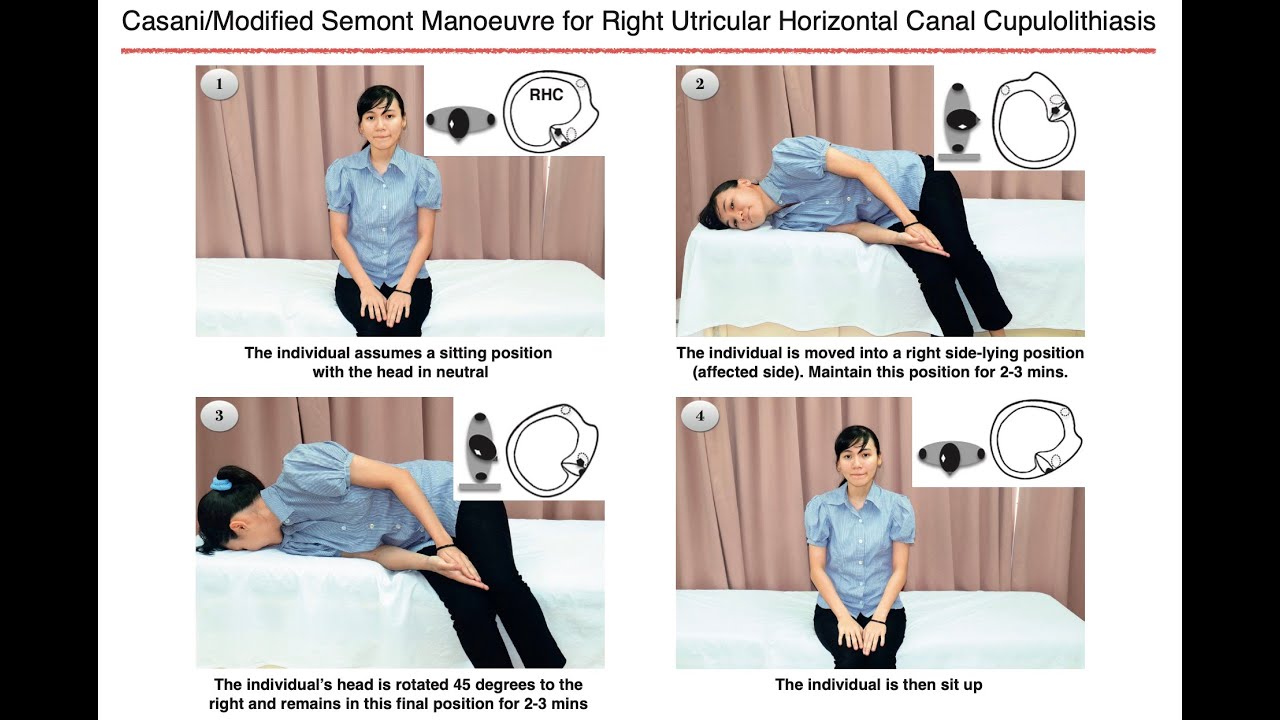 Casani/Modified Semont Manoeuvre for Right Utricular Horizontal Canal ...