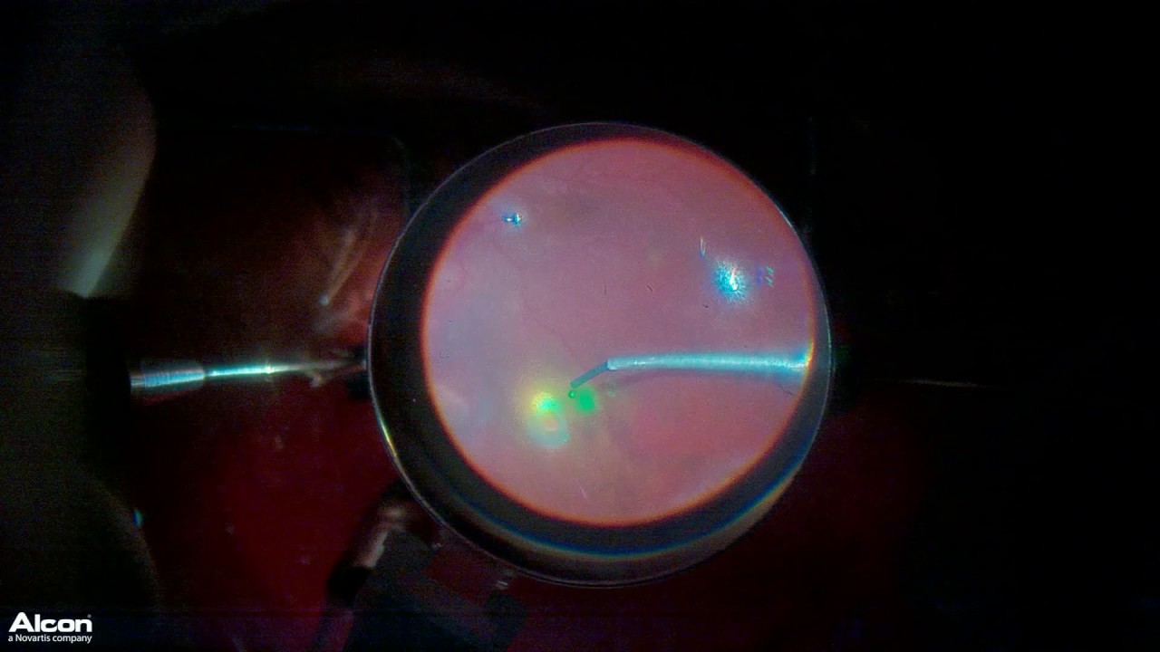 Proliferative vitreoretinopathy (PVR) related RD repair - YouTube