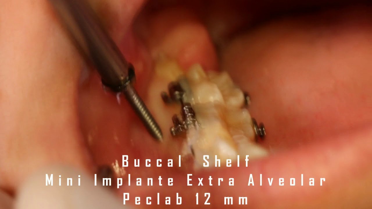 Mini implante Extra alveolar Buccal Shelf - YouTube