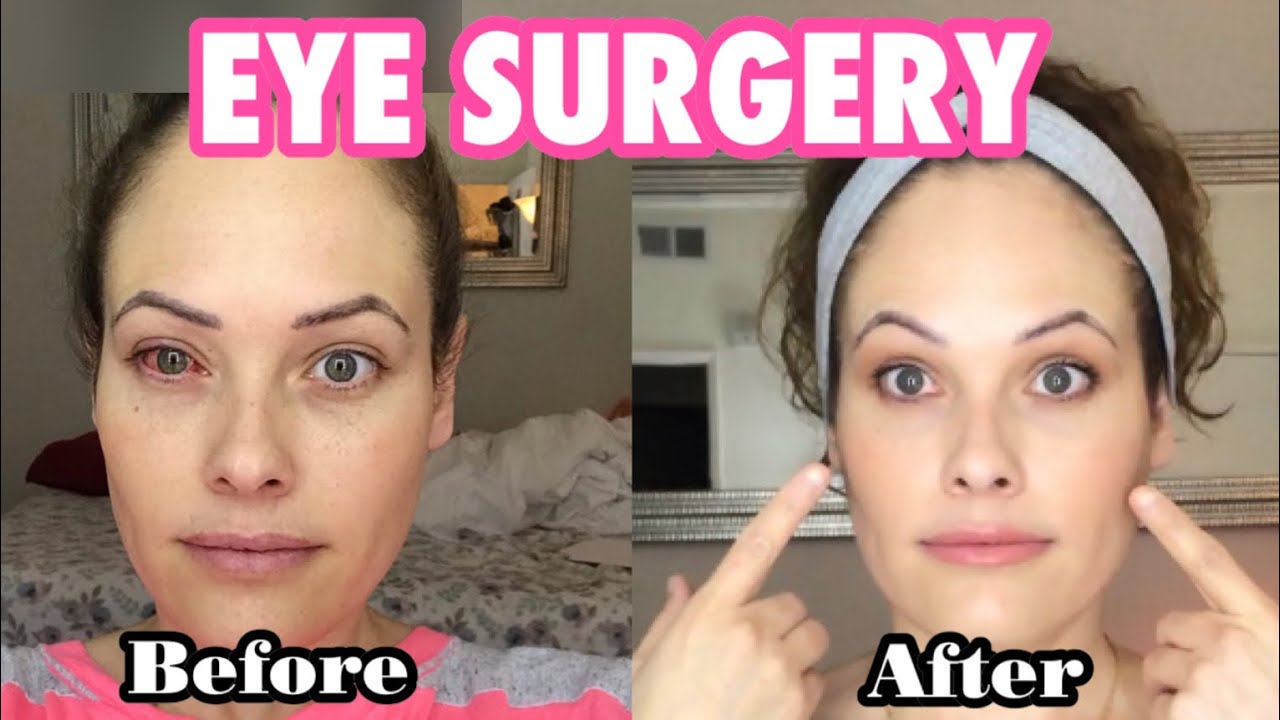 LAZY EYE SURGERY YouTube lazy-eye-surgery-youtube