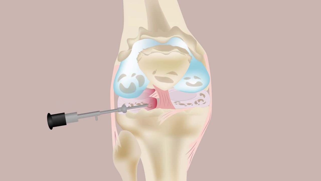 Resorbable polyurethane scaffold reduces pain, improves knee function ...