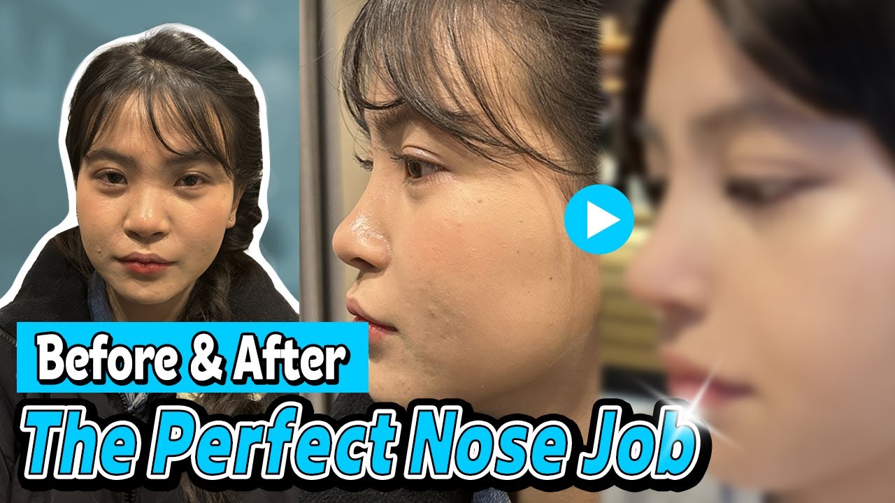 Amazing Nose Job: Before & After! - YouTube