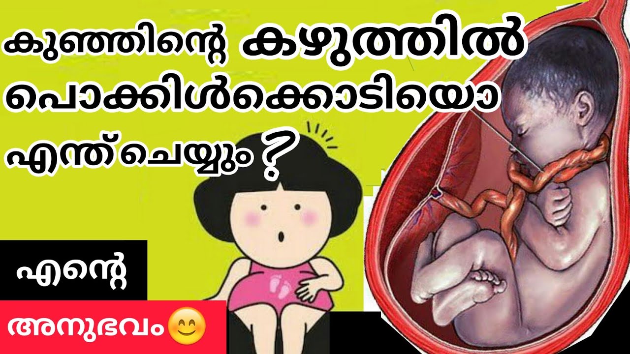 Cord around Neck Why?| Risks | prevent Tips| double loop of Nuchal ...