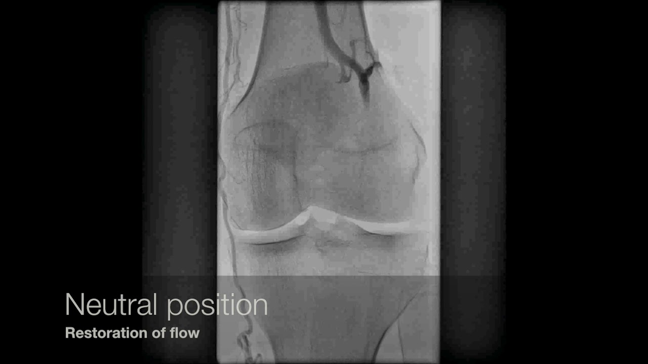 Video 1: PAES Angiography - YouTube