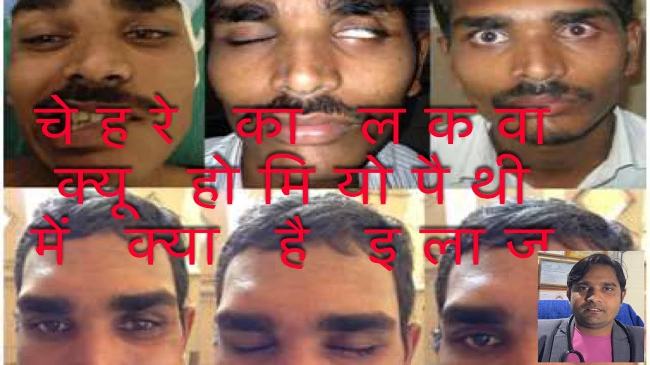 Chehre k lakwa ka homeopathic janakari aur illaj ,bells palsy , lakwa ...