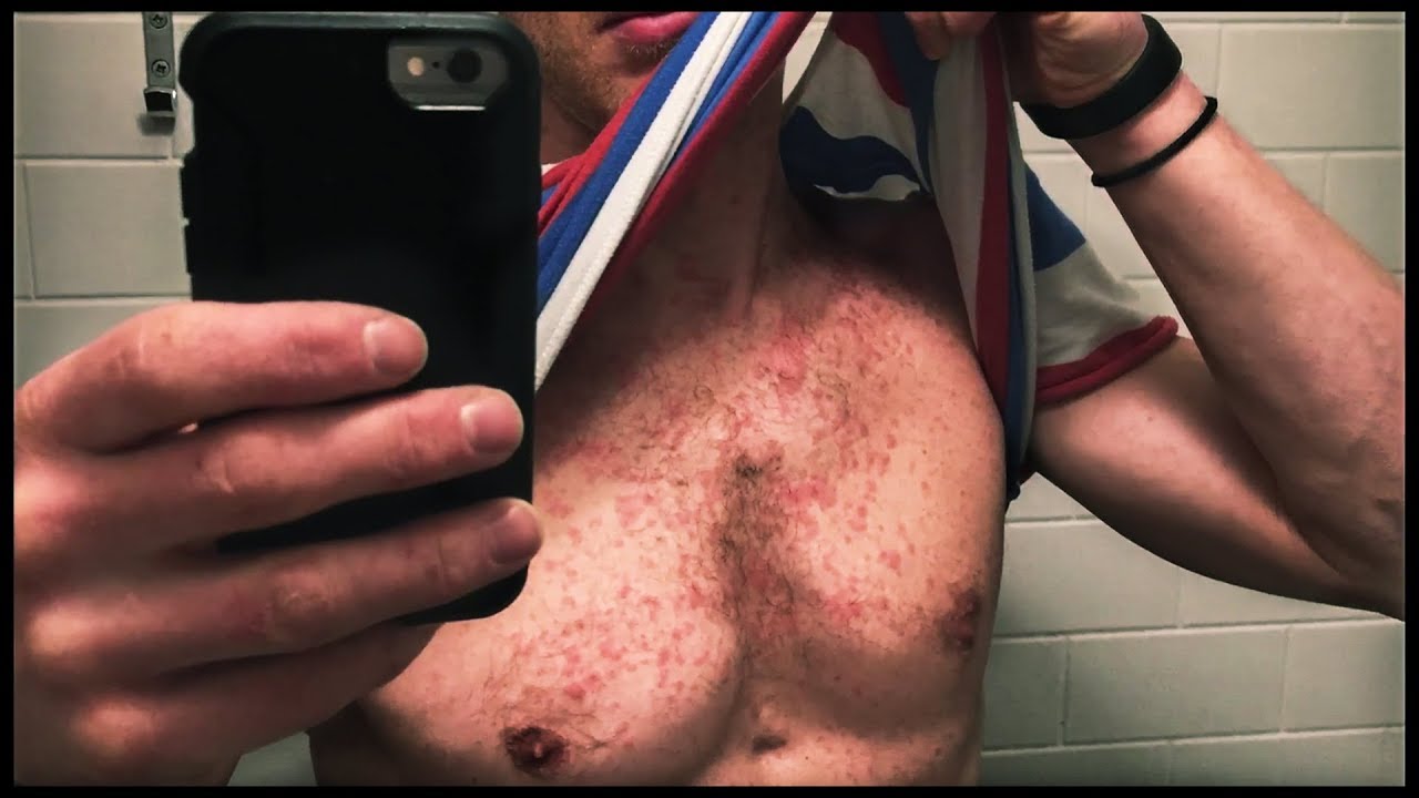 I got Poison Ivy and Broke Out ALL OVER MY BODY - YouTube