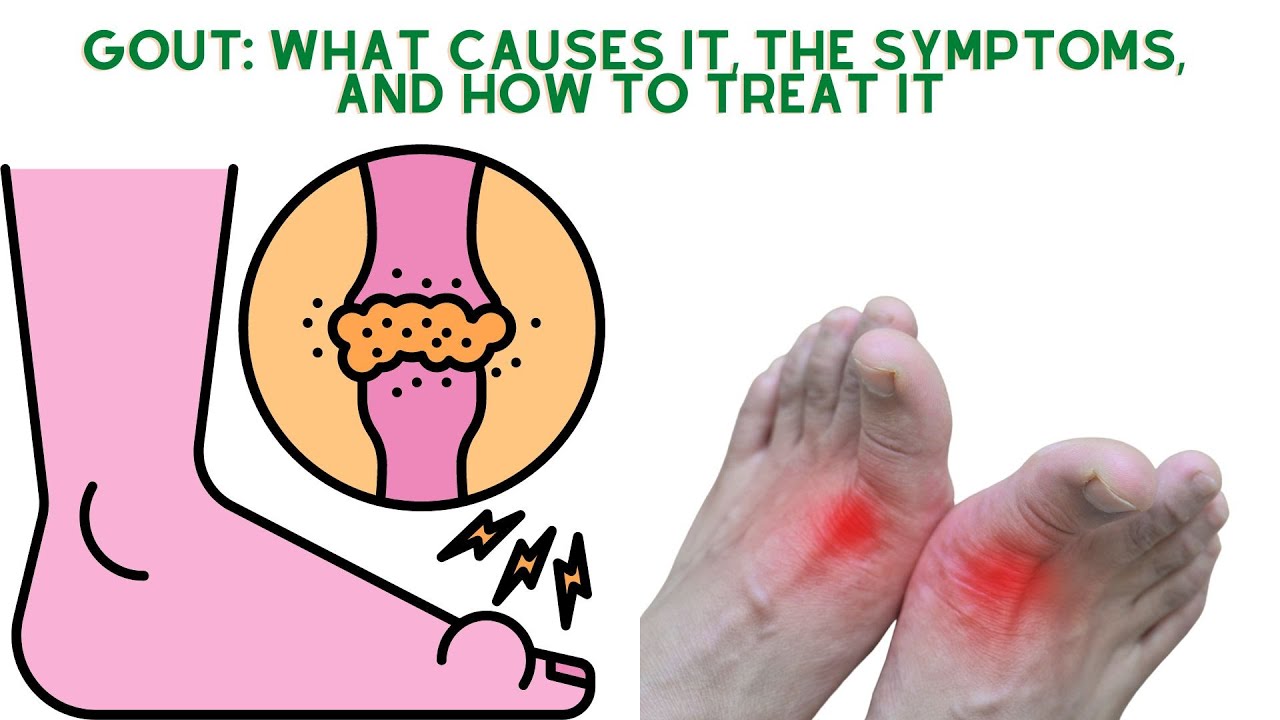 Gout - What Causes It, The Symptoms, And How To Treat It | healthspo ...