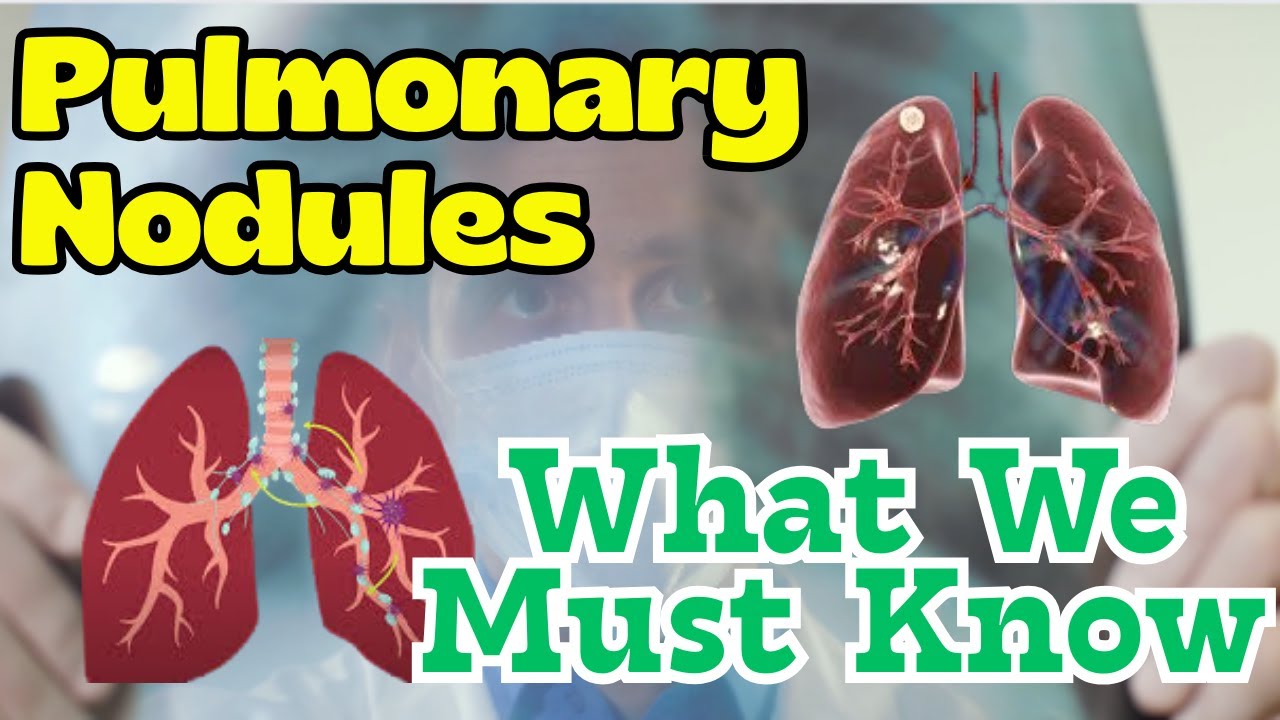 What Does a Pulmonary Nodule Really Mean? What You Must Know？ - YouTube