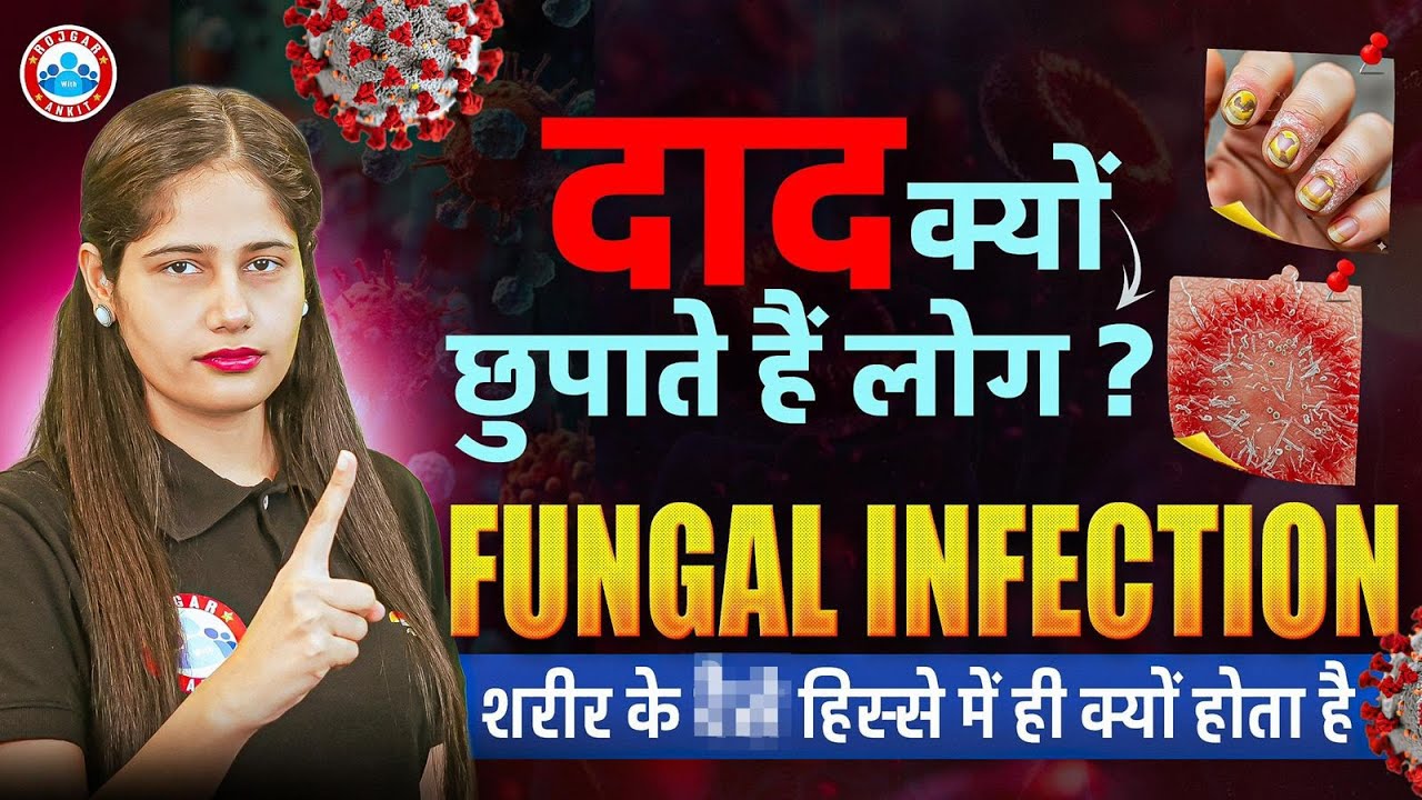 दाद क्यों छुपाते हैं लोग? Fungal Infections In Private Parts | Fungal ...