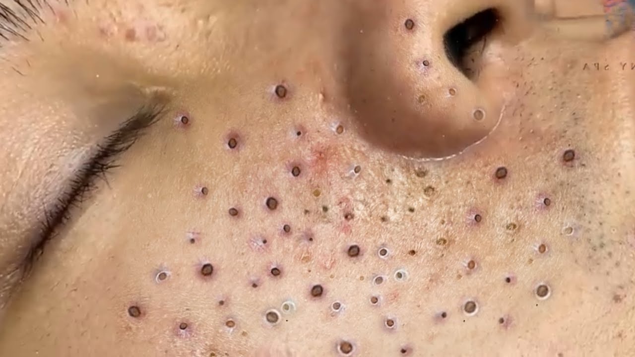 Treatment Of Blackheads And Hidden Acne #023 - YouTube