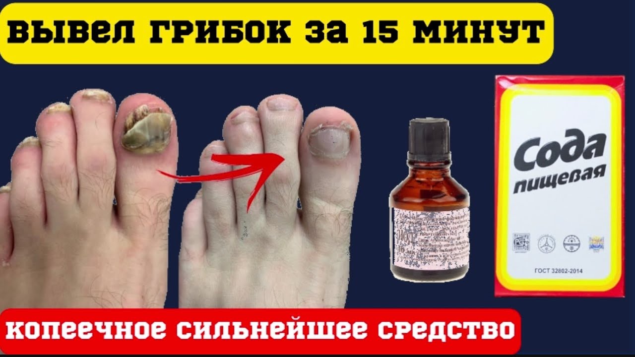 ГРИБОК НОГТЕЙ можно убрать за 15 минут...Как избавиться от ГРИБКА НА ...