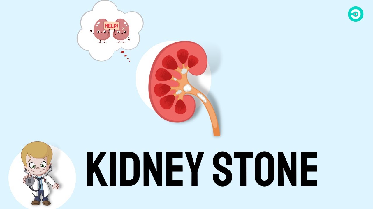 kidney stone: Formation, symptoms, Diagnosis & Surgical Treatment ...