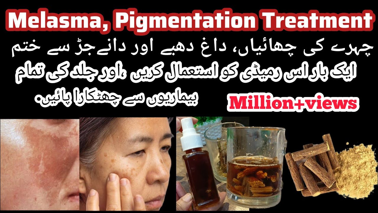Pigmentation, Melasma Treatment!! Get Rid Of Melasma & Pigmentation 100 ...