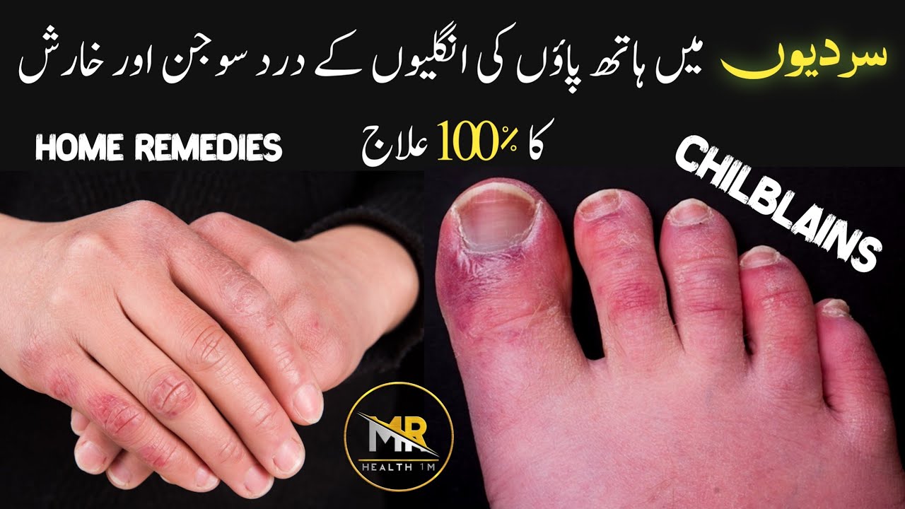 Chilblains Treatment! sardi mein ungli sujan ka ilaj! Mr Health 1M ...