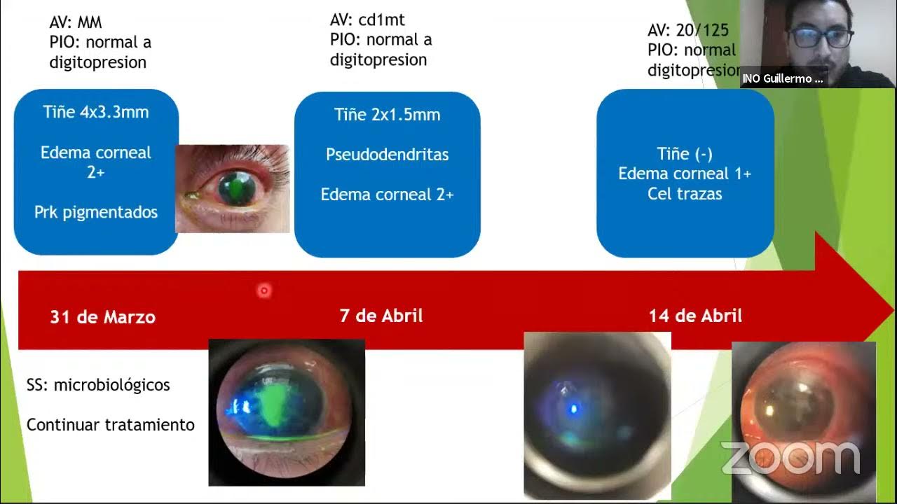 Herpes Zoster Oftálmico. Dr Mesias Dr Alarcón - YouTube