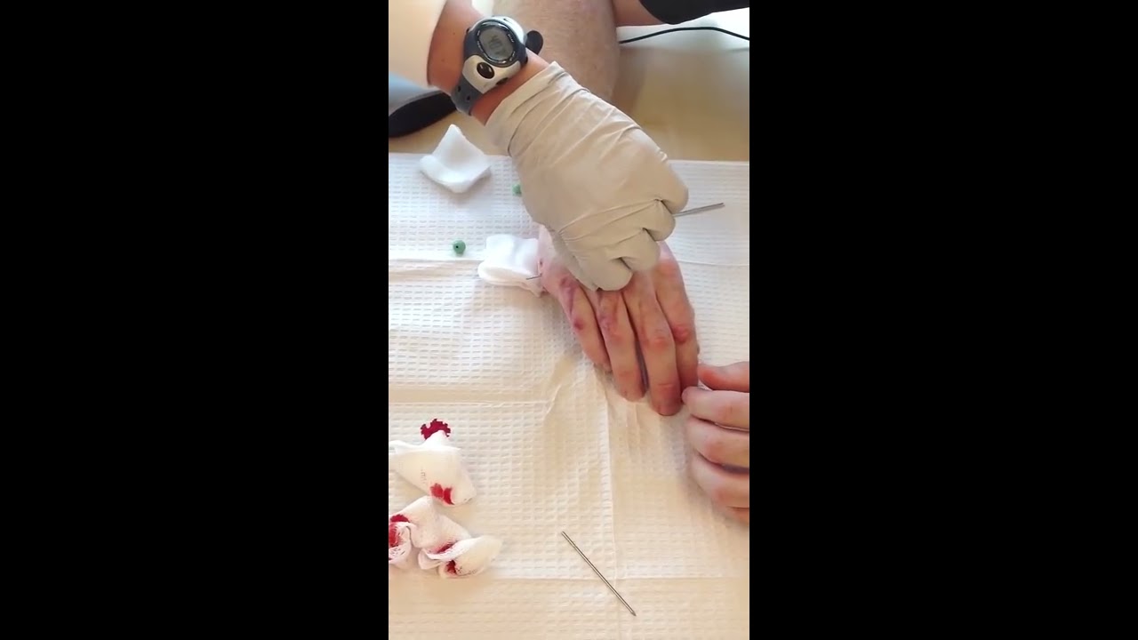 Justin's surgical pin removal - YouTube