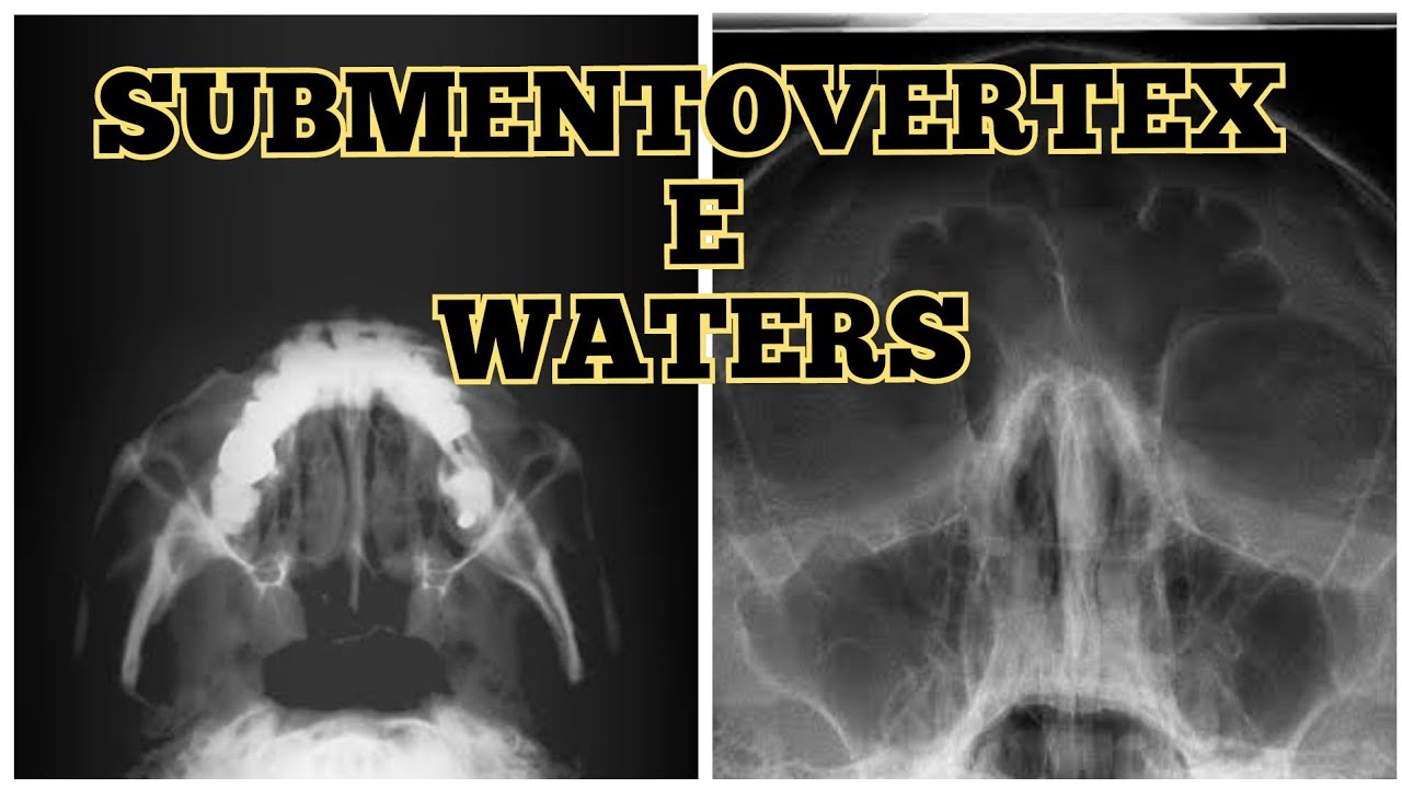 POSICIONAMENTOS DE WATERS E SUBMENTOVERTEX - YouTube