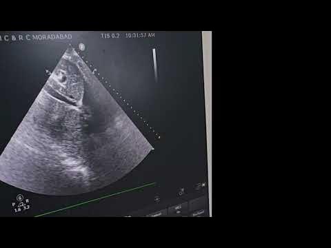 IVC (Inferior vena cava) collapsibility index/video - 182 - YouTube