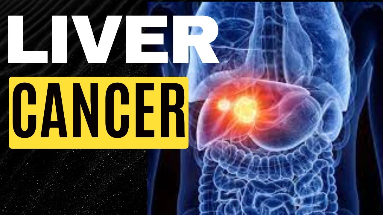Liver Cancer Unveiling its Causes, Symptoms, and Treatments ...