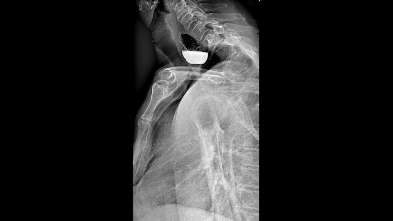 Ampliamento diverticolotomia diverticolo di Zenker per via endoscopica ...