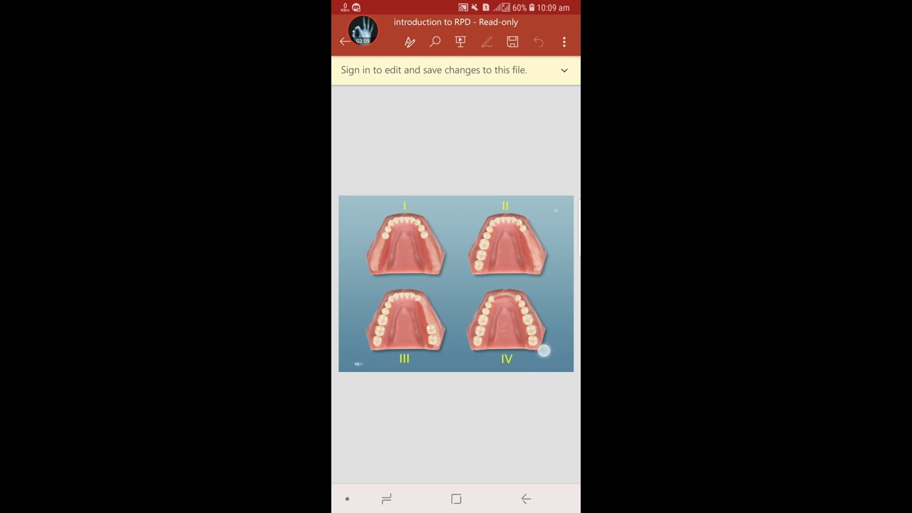 RPD " Removable partial denture " Kennedy classification تصنيفات الأطقم ...