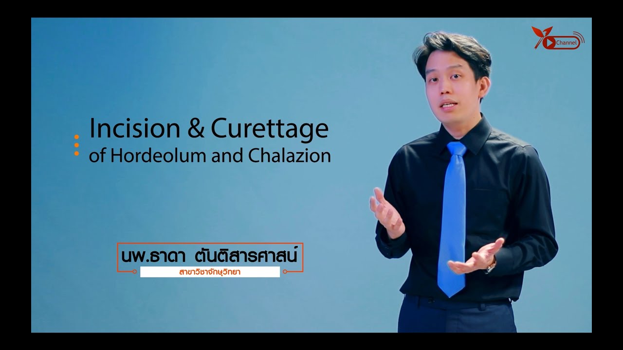 การเจาะกุ้งยิง (Incision&Curettage of Hordeolum and Chalazion) - YouTube