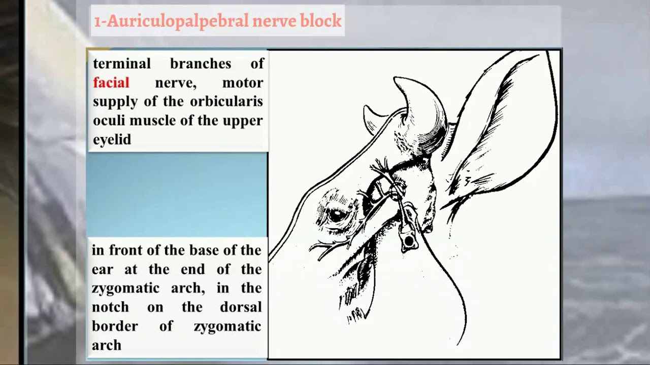 II-REGIONAL ANALGESIA I-PERI-NEURAL A-Regional Analgesia of Head 2-The ...