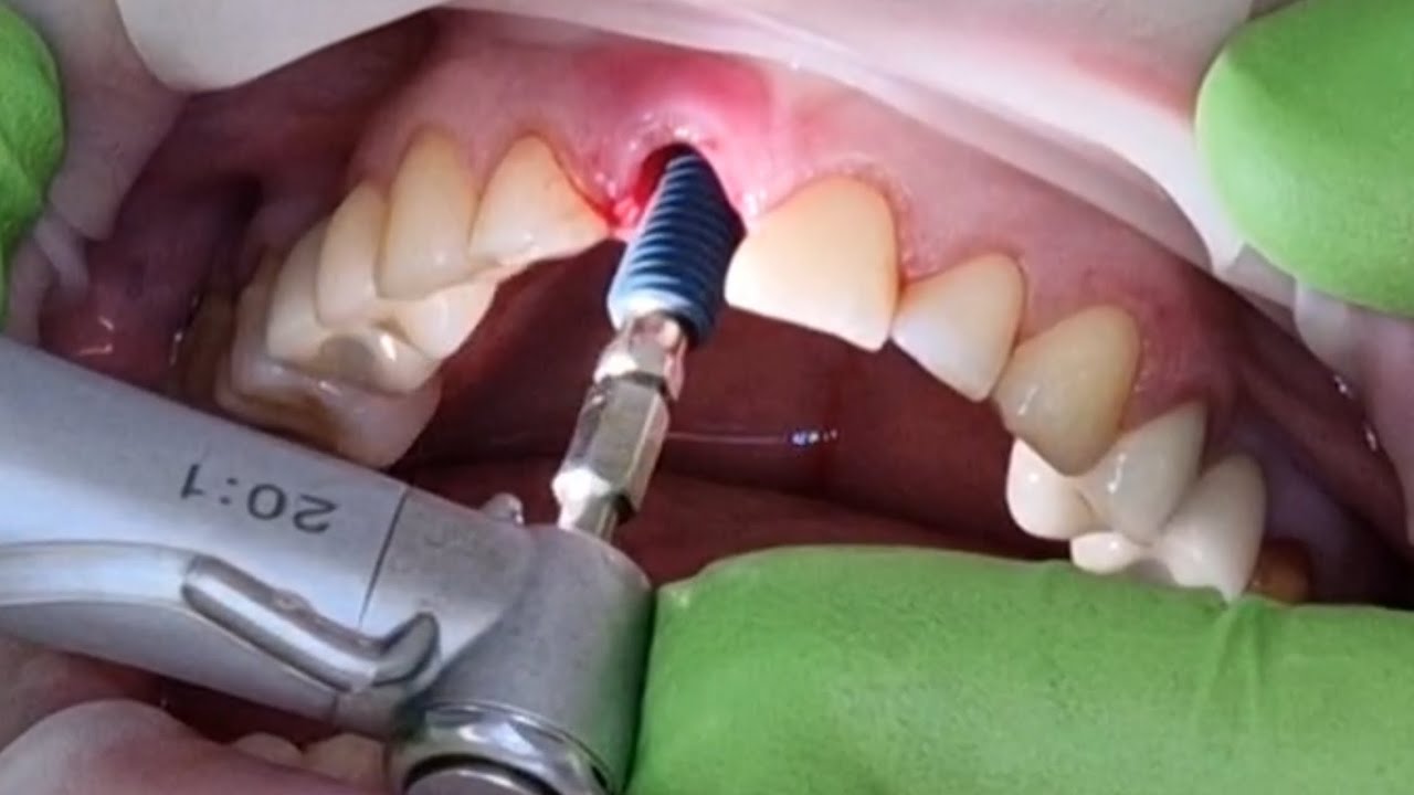 Stomatologie Chisinau Botanica TerraDent Moldova Implant Dentar stomatologie-chisinau-botanica-terradent-moldova-implant-dentar