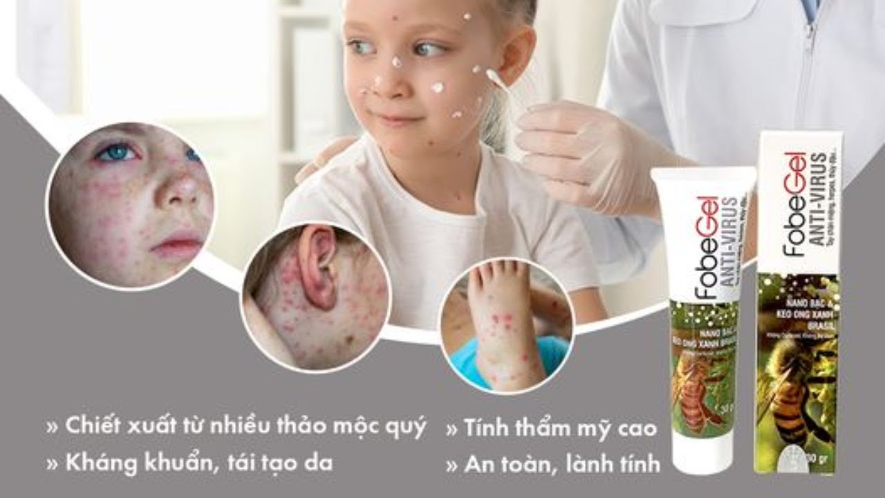 Gel Bôi Thủy Đậu, Zona, Tay Chân Miệng FOBE GEL ANTI VIRUS | Dược phẩm ...