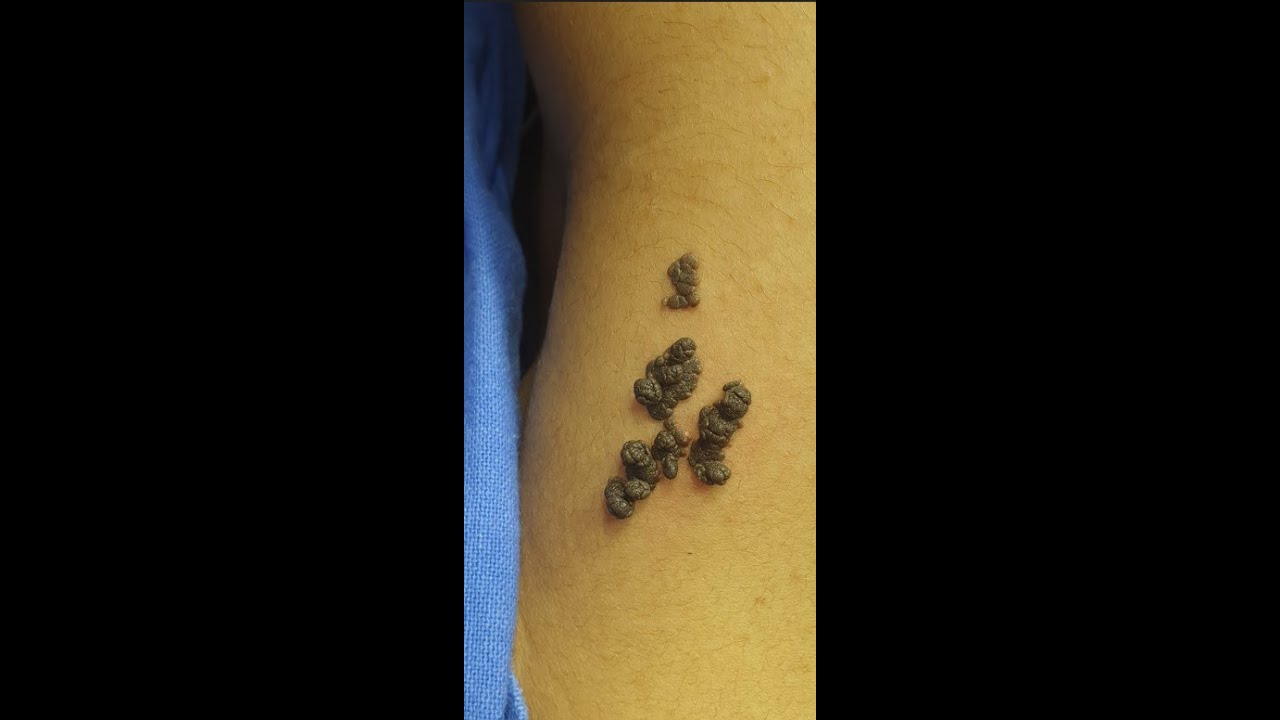 Multiple Seborrheic Keratosis Shoulder: Shave Excision with Radio frequency - YouTube