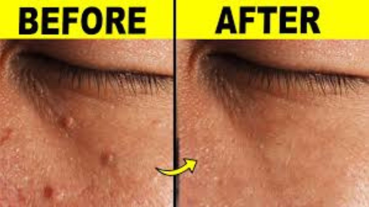 9 Effective Ways to Remove Skin Tags at Home Safely - YouTube