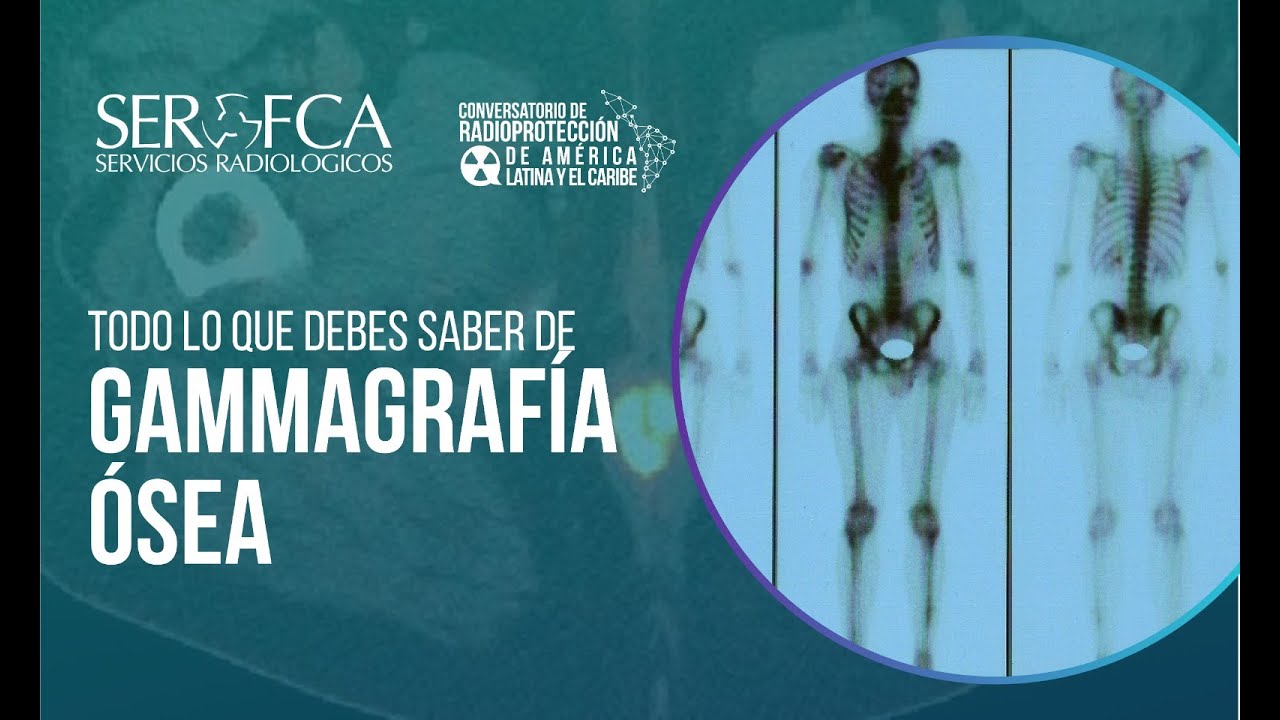 Conversatorio sobre Gammagrafía ósea: Qué es y para qué sirve. - YouTube