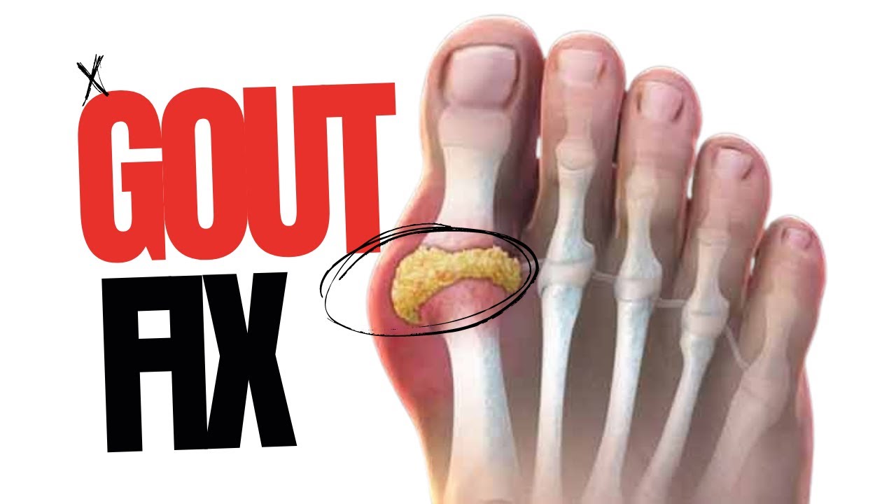 Gout Relief: Natural Solution - YouTube