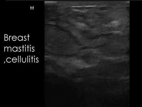 CASE 705 breast mastitis cellulitis - YouTube