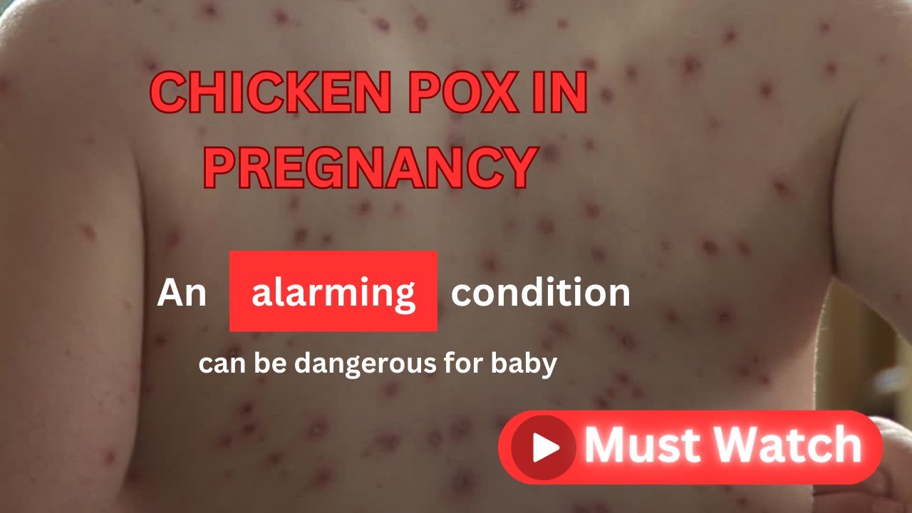 Chickenpox in Pregnancy: Is Your Baby at Risk? #chickenpox # ...