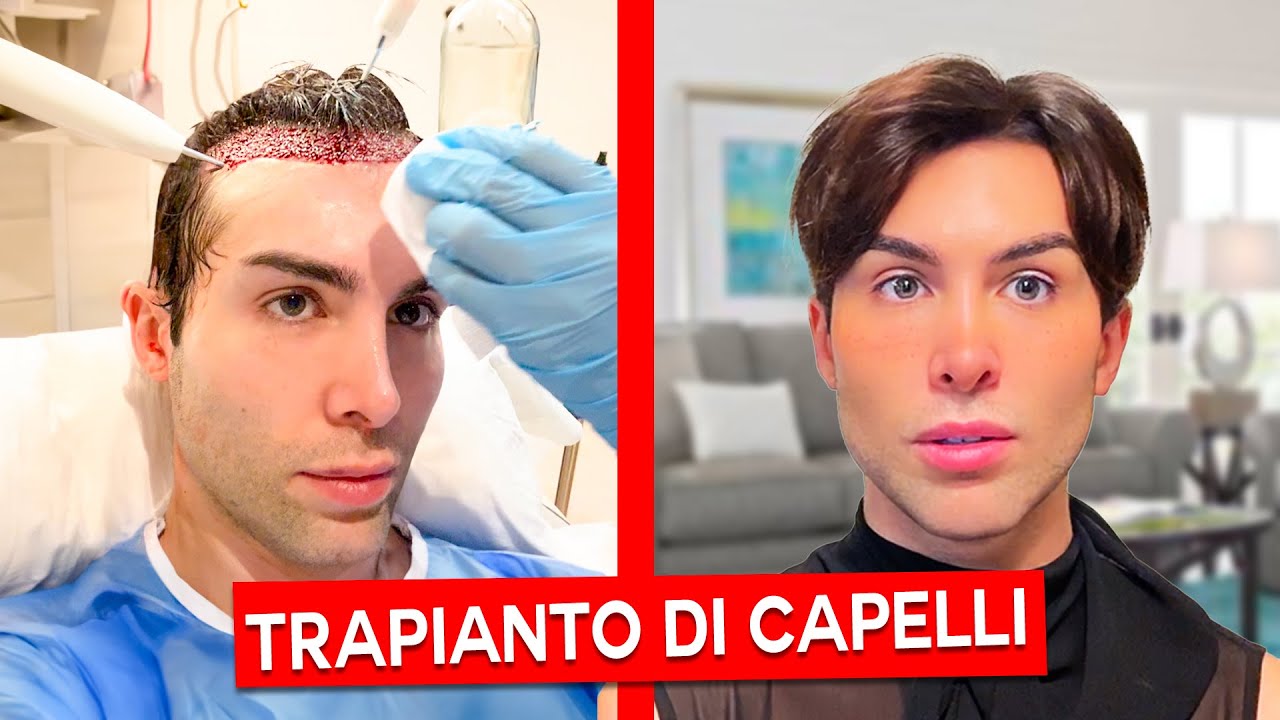TRAPIANTO DI CAPELLI: LA MIA ESPERIENZA | GIANMARCO ZAGATO - YouTube