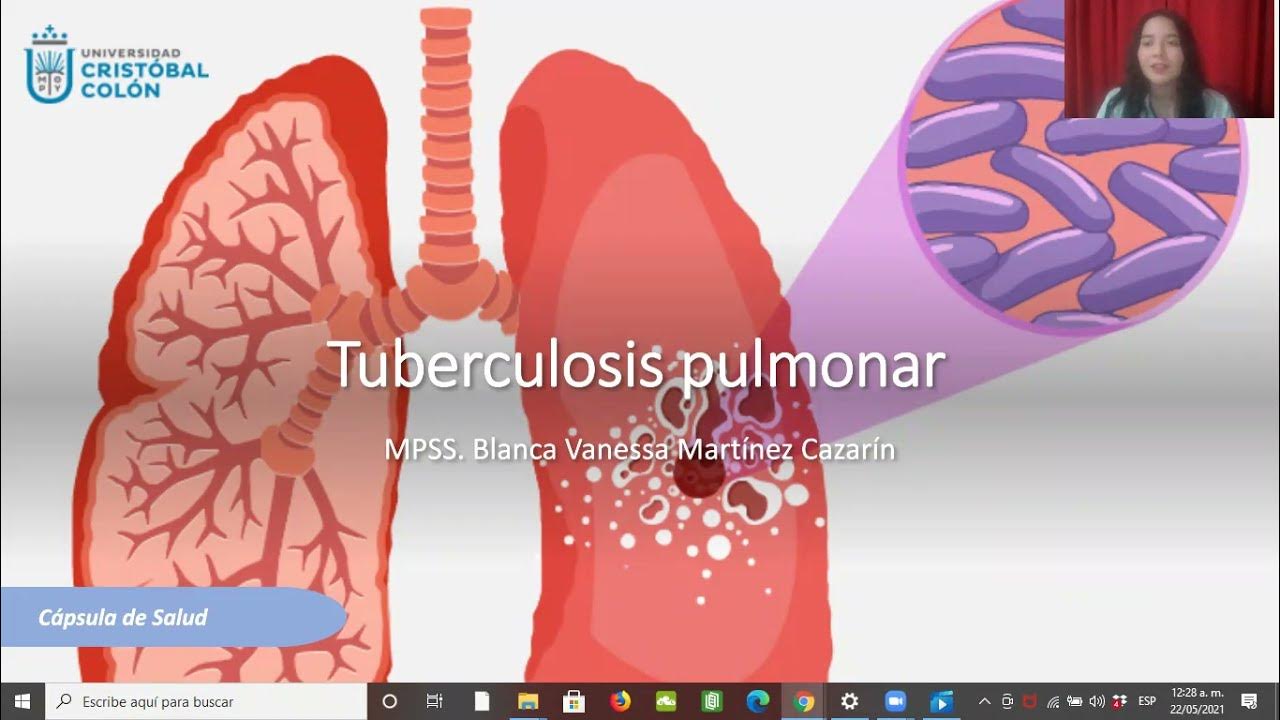 Tuberculosis pulmonar - Factores de riesgo y síntomas - YouTube