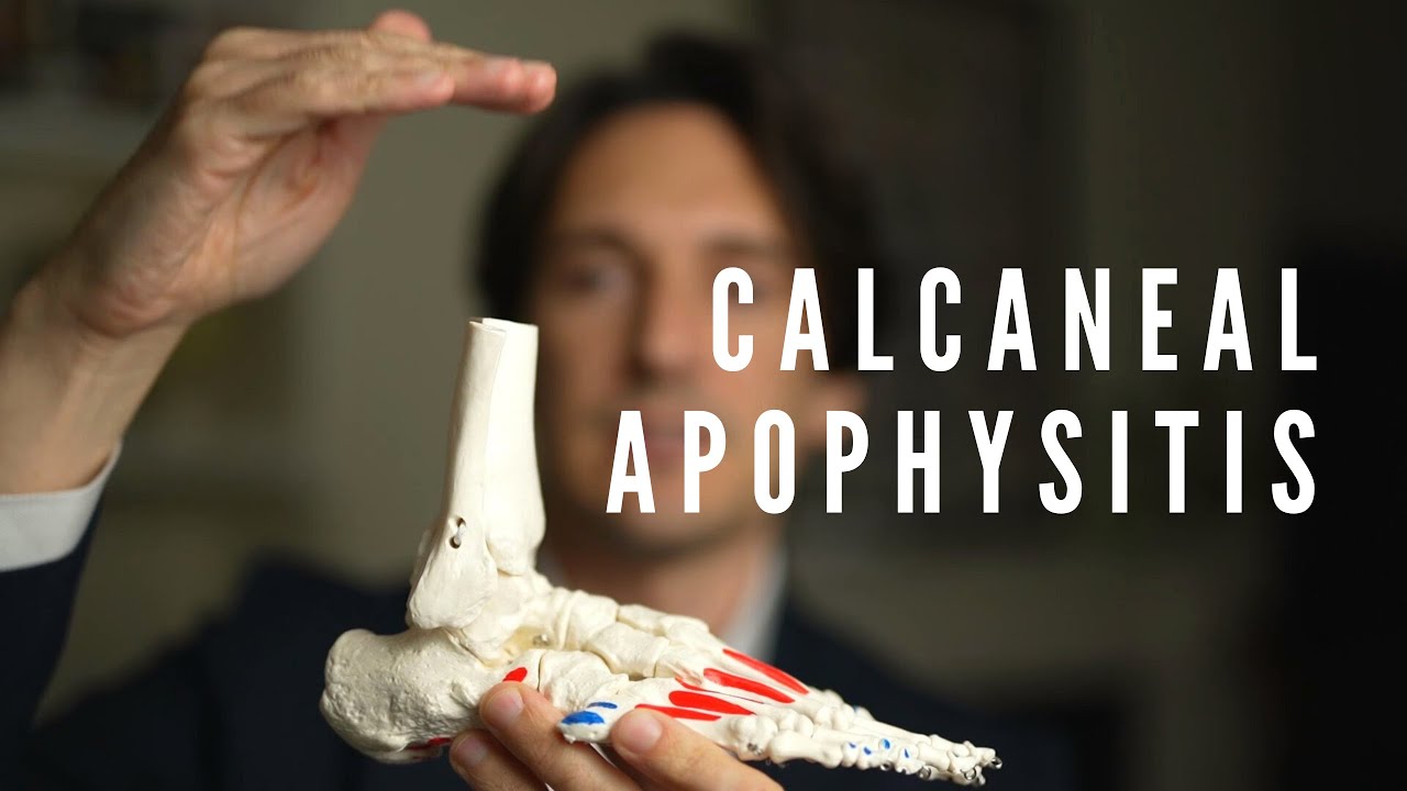 Calcaneal Apophysitis / Sever's Disease - Heel Pain in Children - YouTube