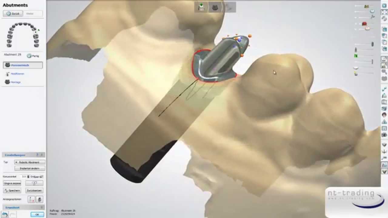 NT Dental - Preform Design in 3shape® - YouTube