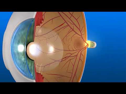 Photodynamic Therapy For Macular Degeneration - YouTube