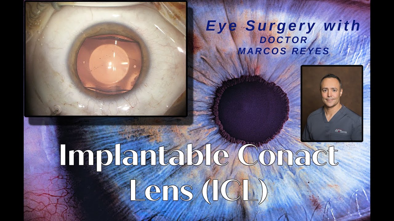 Visian ICL (Implantable Contact/Collamer Lens) - YouTube