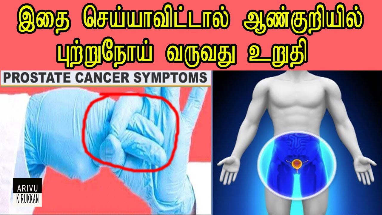 Prostate Cancer Symptoms In Tamil Health News YouTube