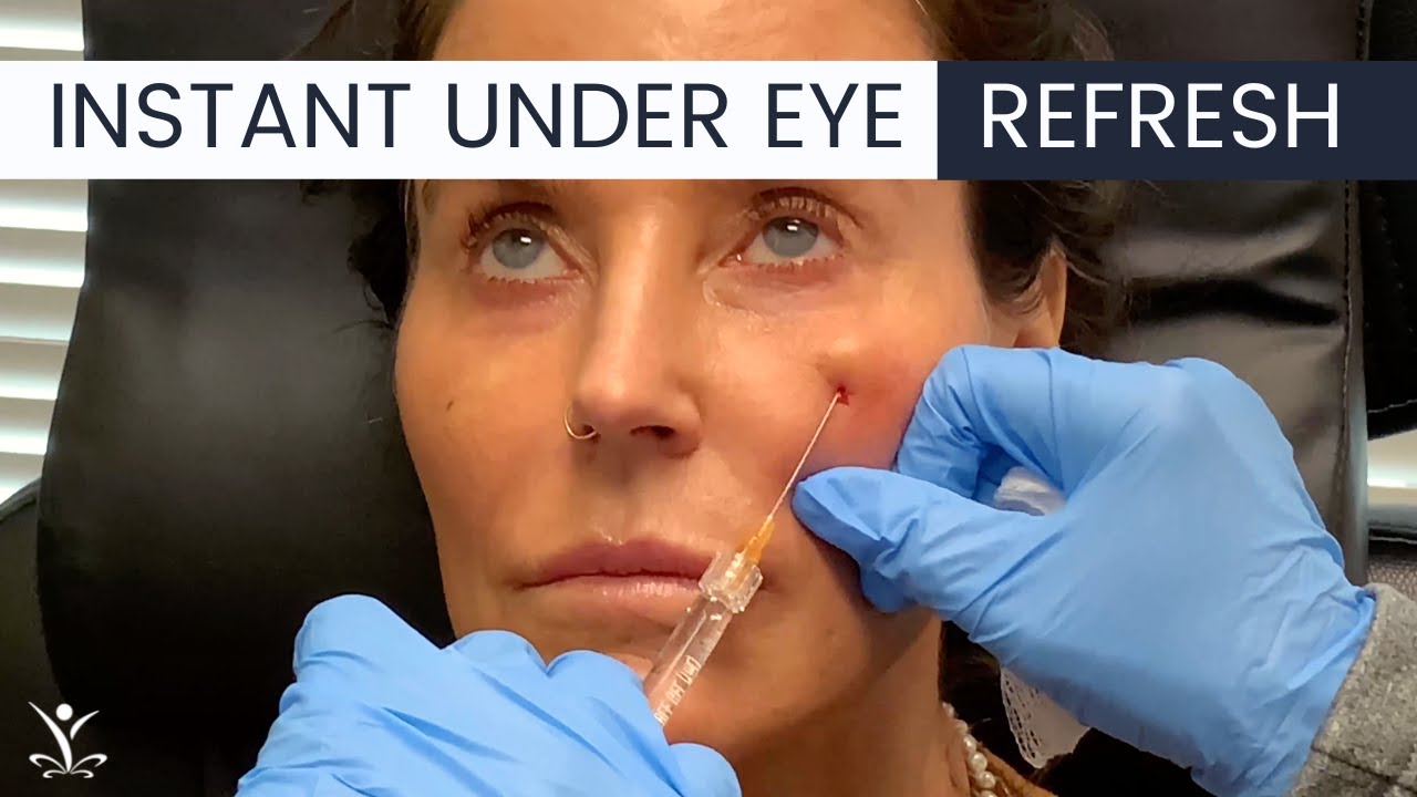 Tear Trough Filler -- Quick and Safe with a Cannula! - YouTube