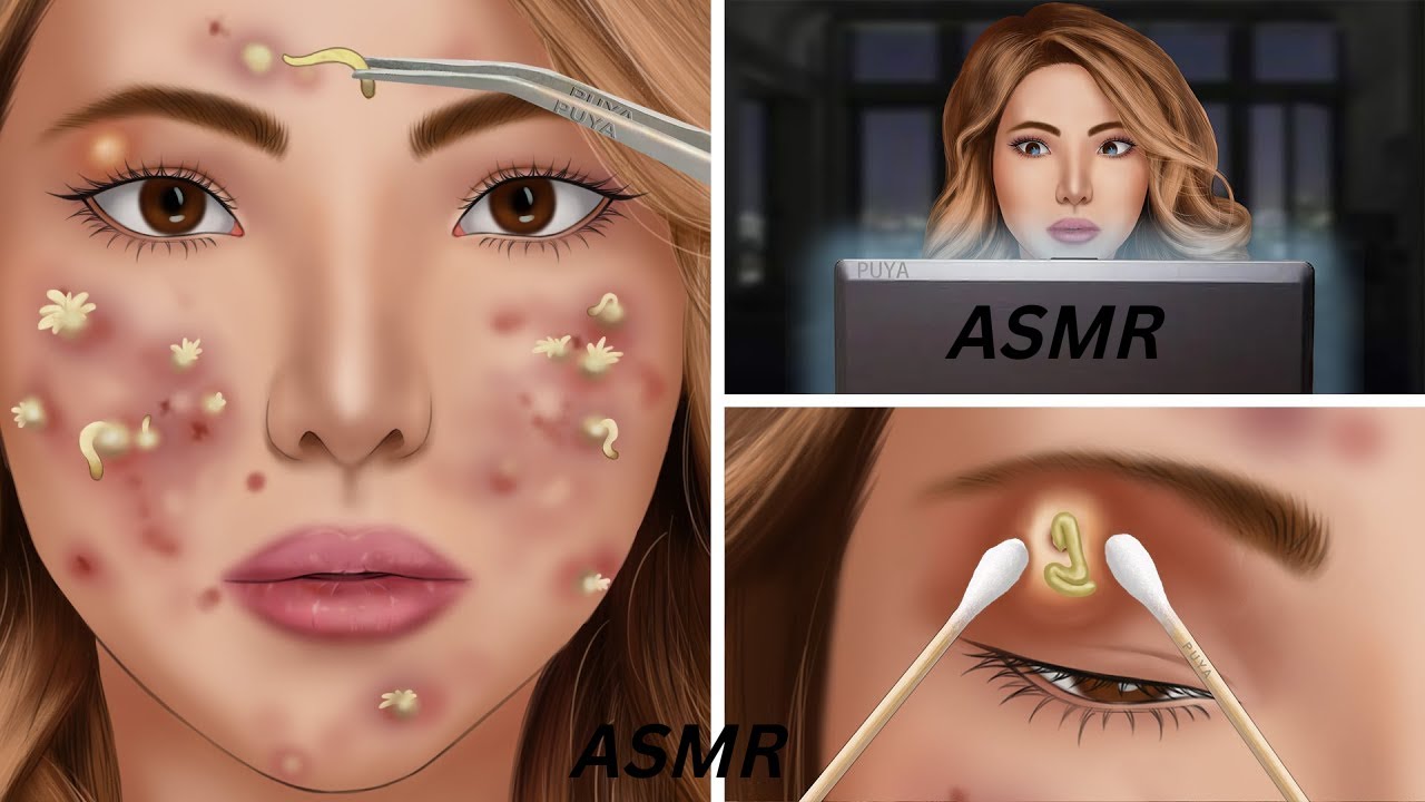 ASMR Acne, Big Blackhead Removal Animation/ASMR CARE ANIMATION ...