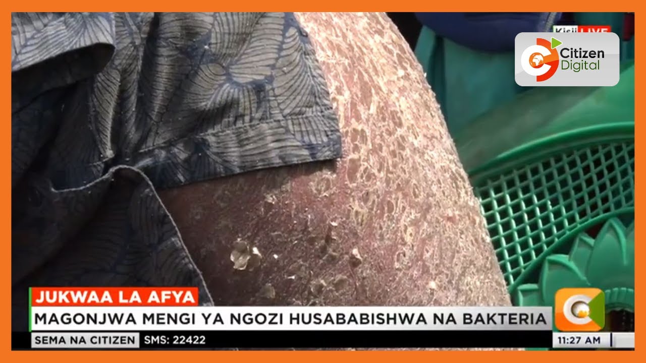 Kilio cha mama Florence: Jinsi ugonjwa wa ngozi umehangaisha mama ...