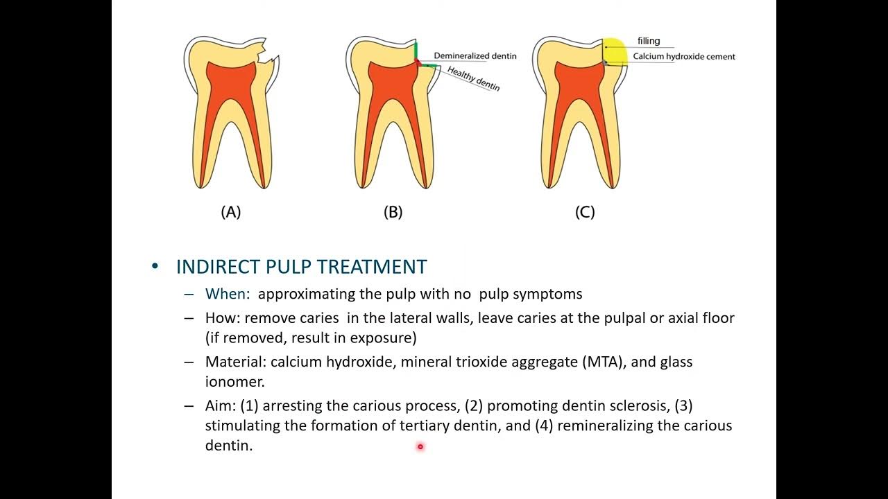Indirect pulp capping: management of deep carious lesion: Ca(OH)2 liner ...