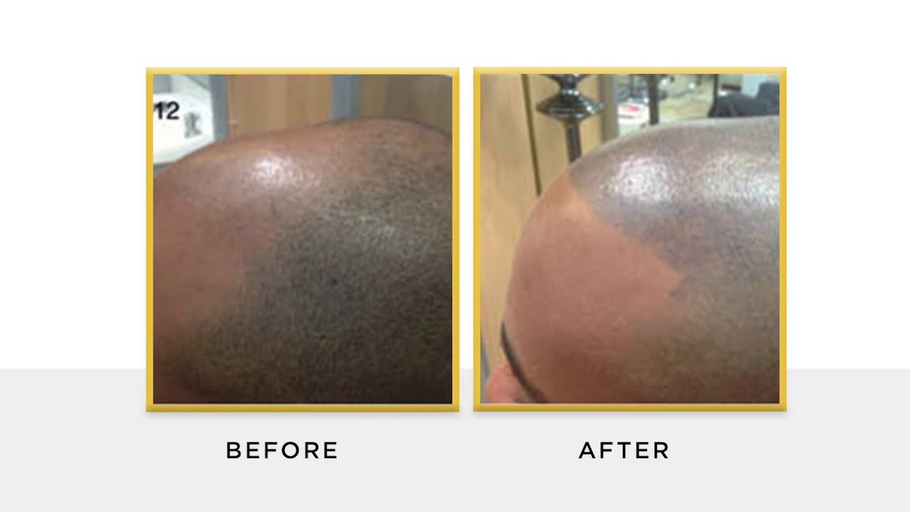 Before and After Scalp Micro Pigmentation - Hair Tattoo by Hair ...