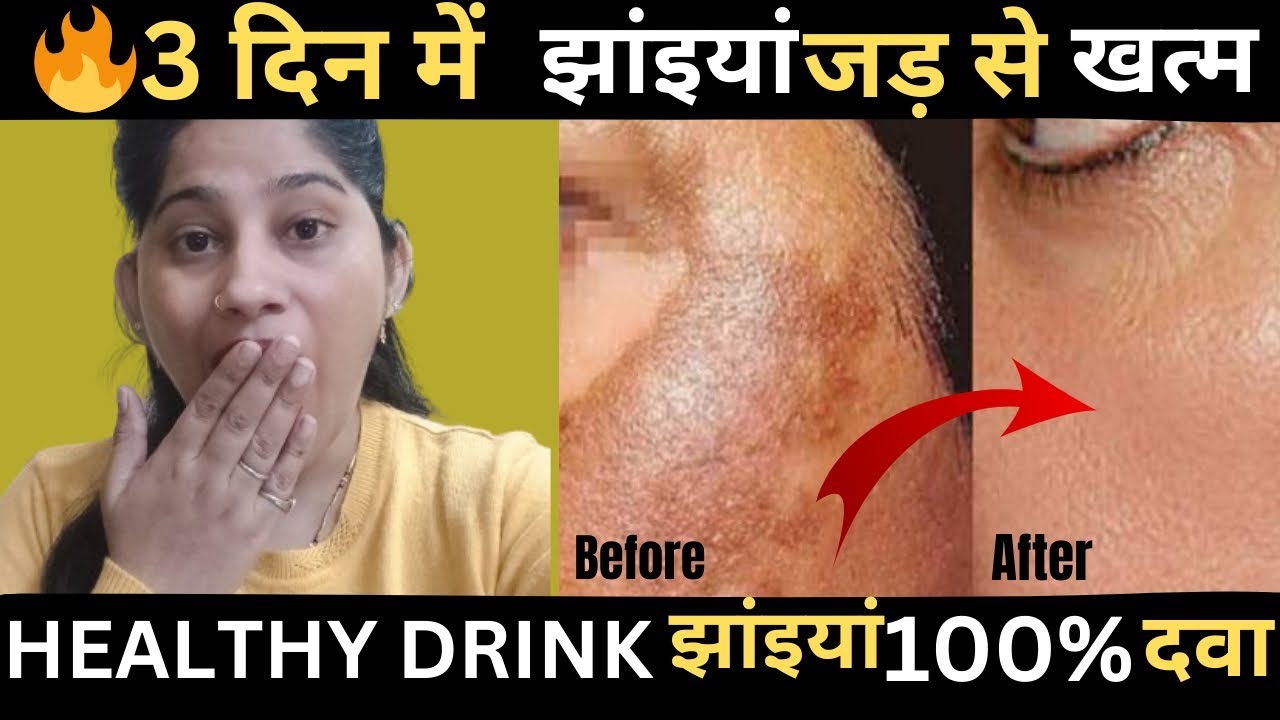 🔥𝟯दिन में झांइयांं जड़ से खत्म। 𝗵𝗼𝘄 𝘁𝗼 𝗴𝗲𝘁 𝗿𝗶𝗱 𝗼𝗳 𝗵𝘆𝗽𝗲𝗿𝗽𝗶𝗴𝗺𝗲𝗻𝘁𝗮𝘁𝗶𝗼𝗻 𝗮𝘁 ...