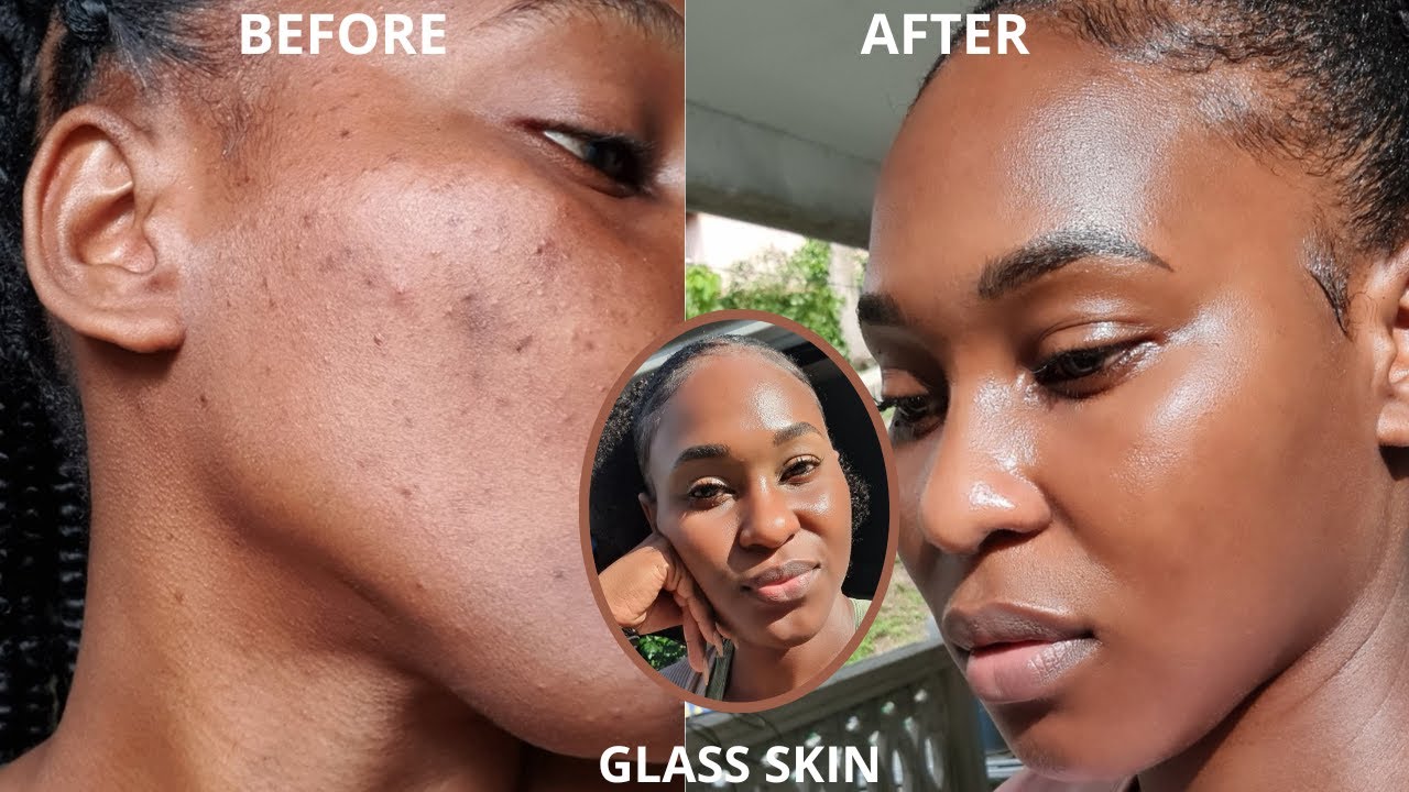 HOW I CLEARED MY ACNE FOR GOOD IN TWO WEEKS - YouTube