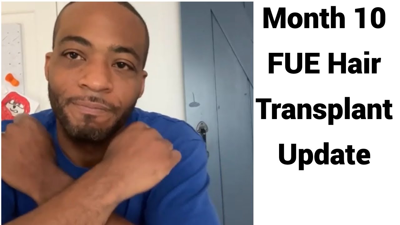 African American-Hair of Istanbul/ 4K Graft FUE Hair Transplant: 10 Month Update - YouTube
